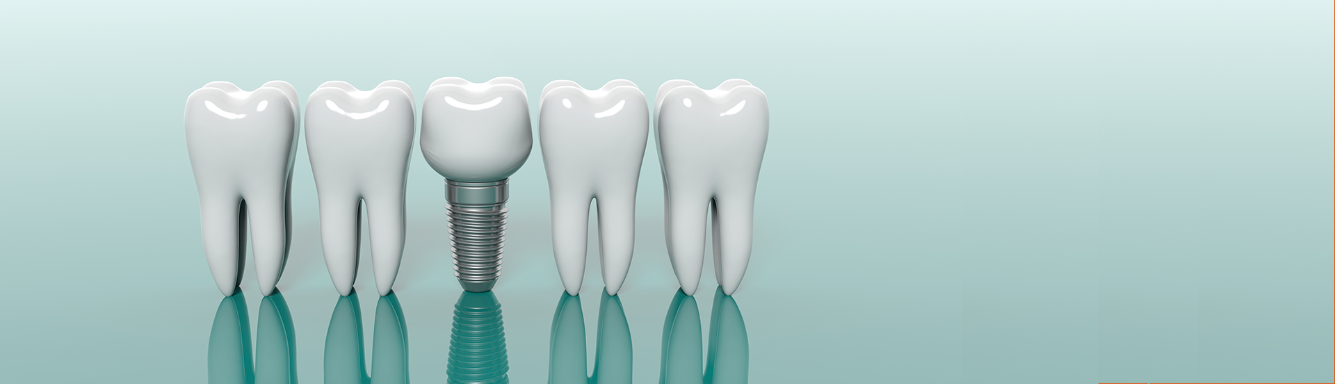 Kinder-Zahnversiegelung | Dr-Schmuck-Dental